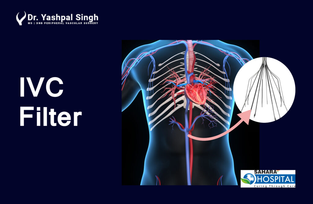 IVC फ़िल्टर कितना जरूरी!! - vascularsurgeonlucknow.com